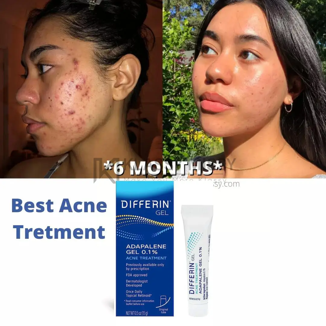 Differin® Gel Adapalene Gel 0.1% Acne Treatment 15g
